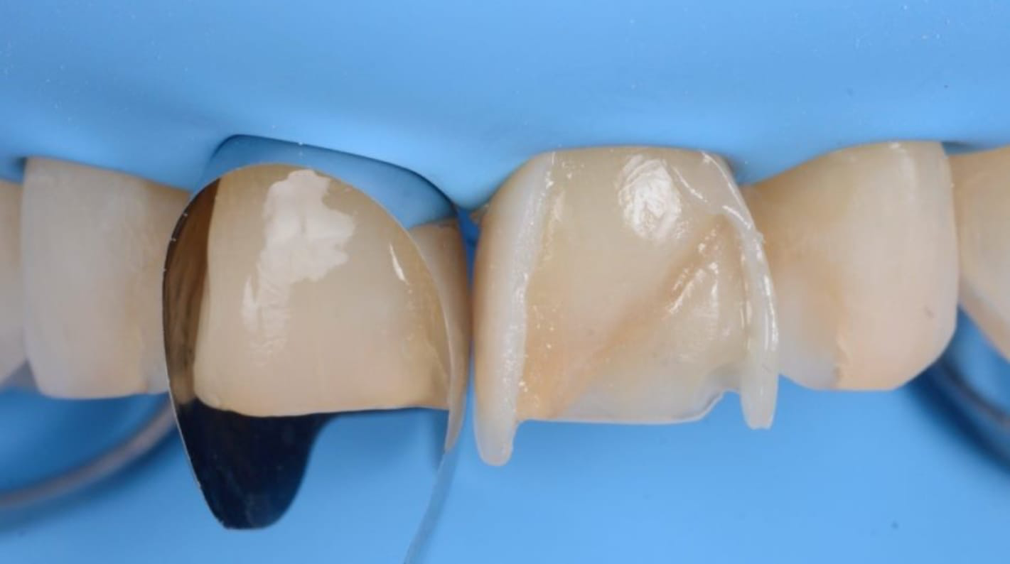Direct dental composite veneers: advantages and disadvantages compared ...